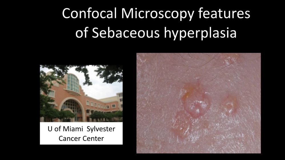 Sebaceous Hyperplasia Archives Confocal Microscopy 101